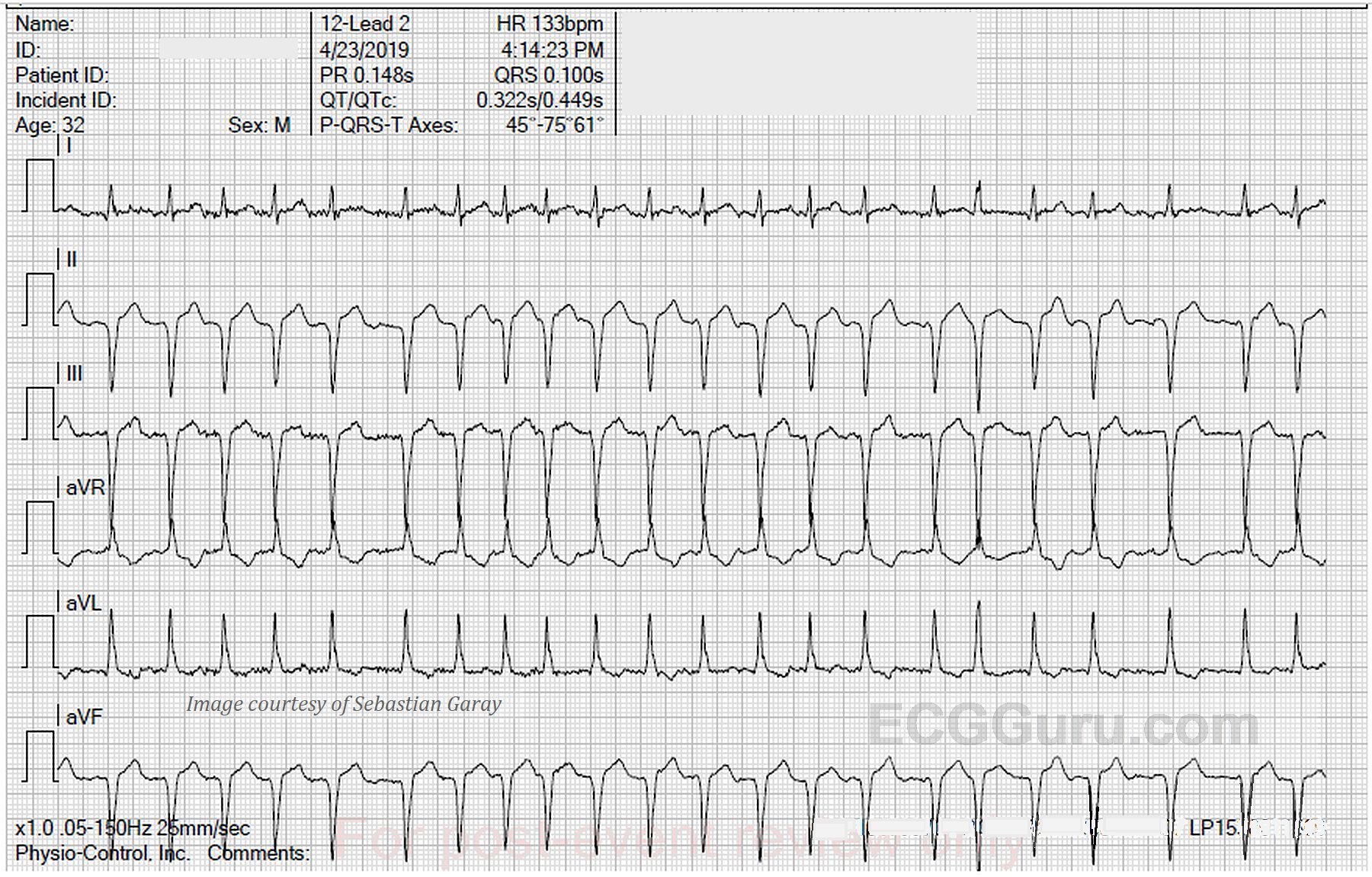 Atrial Fibrillation And Type 2 M I Ecg Guru Instructor Resources